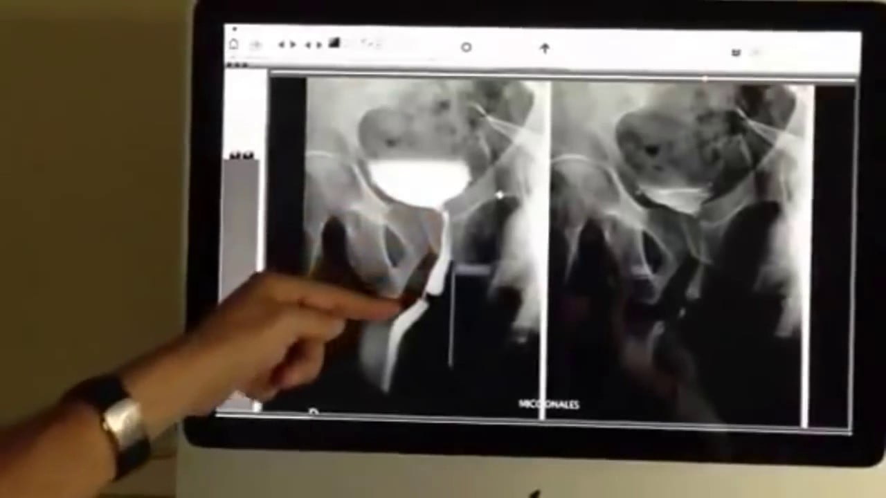 Comment se déroule une pyélographie rétrograde